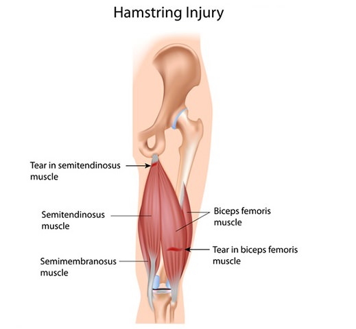 Hamstring Injury | Local Physio